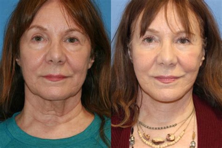 Patricia Heaton Cosmetic Surgery: Before And After Transformations ...